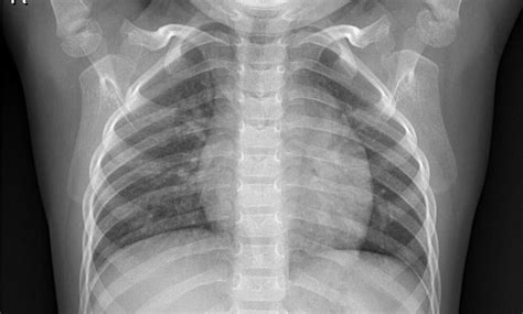 X Ray Image Classification The Easy Way Towards Data Science Artofit