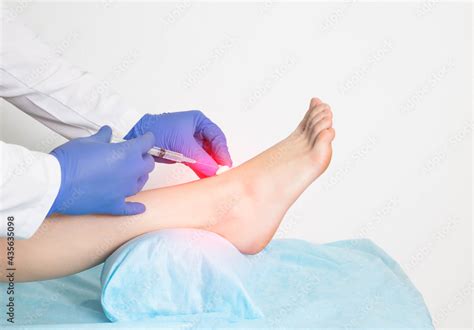 The Doctor Gives An Intra Articular Injection Of An Ankle Block To A Patient Who Has A Ligament