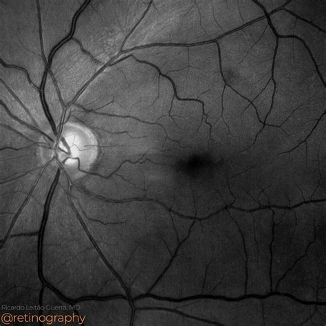 An Inadvertent Touch To The Retina During Ilm Peeling Can Cause An Arcuate Defect Best