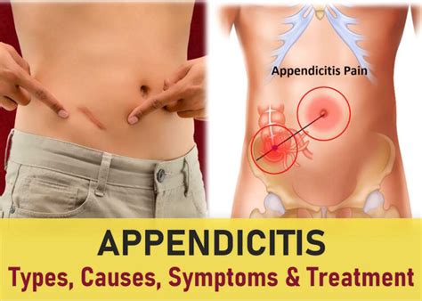 Appendicitis Types Causes Symptoms And Treatment