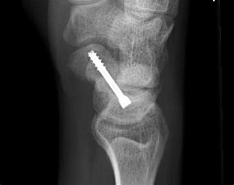 Fracture The Bone School