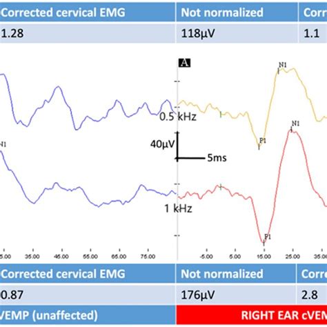 Representative CVEMP Data In A 50 Year Old Male Patient With Unilateral Download Scientific