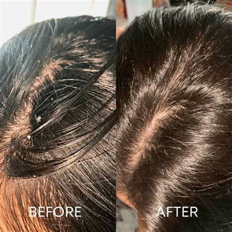 Do Scalp Scrubbers Actually Work Hair Experts Resolve Myths