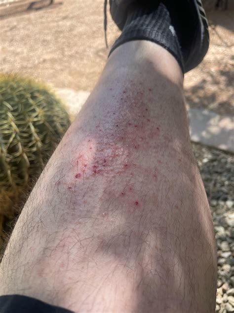 Lower Leg Rash For Over A Year R Dermatologyquestions