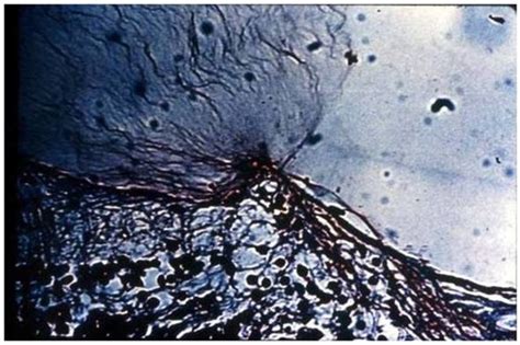 Peripheral Retinal Abnormalities NYMAN POST SEG FINAL Flashcards Quizlet