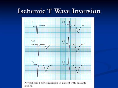 Scott Ewing D O Cardiology Fellow Lecture 4 Ppt Download
