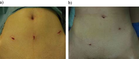Laparoscopic Myomectomy Scars
