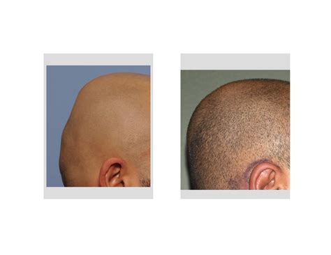 Case Study Minimal Incision Bone Cement Occipital Skull Augmentation