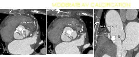 Aortic Valve Calcification Complementary Parameter For Aortic