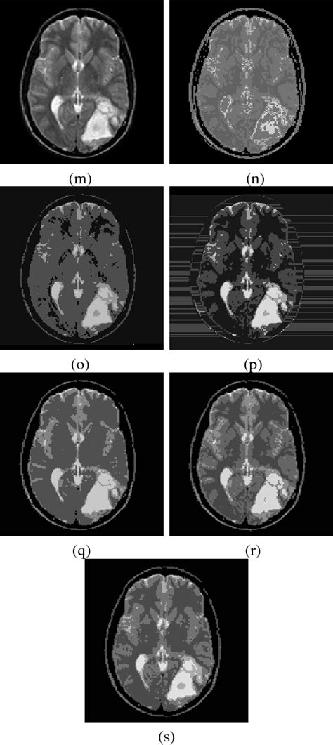 Figure 1 From Medical Image Segmentation Using Rough Spatial Kernelized