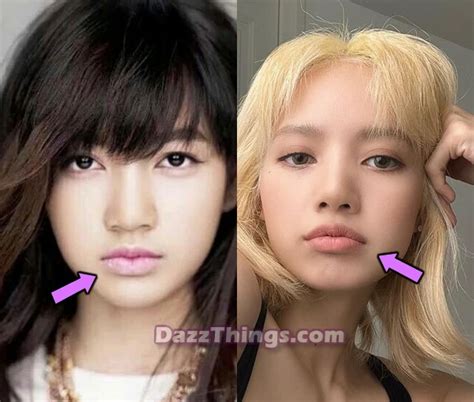 Lisa Blackpink Plastic Surgery Comparison Photos