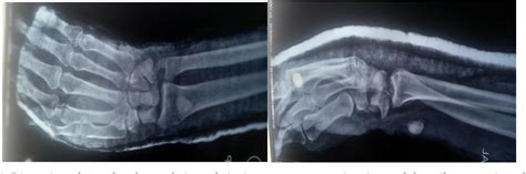 Figure 1 From Trans Scaphoid Lunate Fracture Dislocation A Case Report