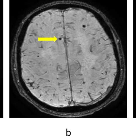 Neuroimaging Characteristics Of Cerebral Microbleedscmbs In Mr