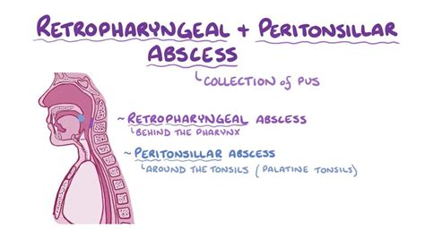 Peritonsillar Abscess Anatomy