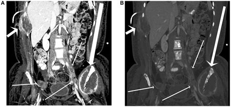 A 17 Year Old Female With H3f3a G34r Mutated Infiltrative Glioma A