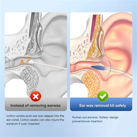 Weuany Ear Wax Removal Kit Safe And Effective Manual Ear Irrigation