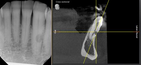 External Resorption Vs Internal Resorption