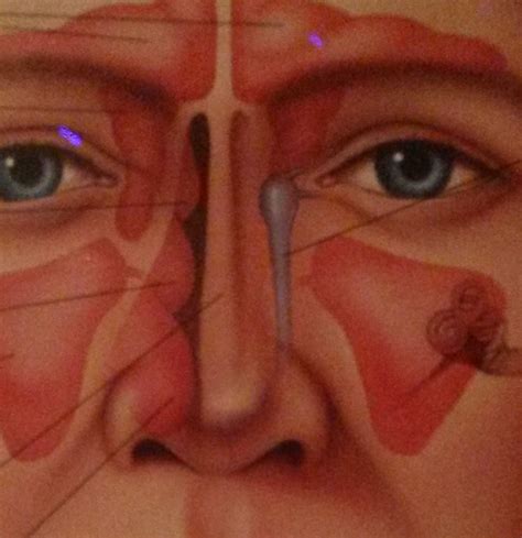 Curing Sinusitis Using A Non Pharmaceutical Intervention Dr Nancy