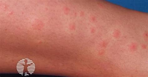 Insect Bites Image