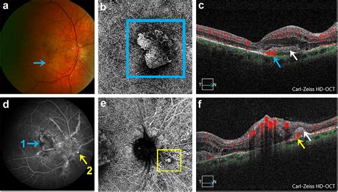 The Role Of Multimodal Imaging In Characterization And Monitoring Of Choroidal