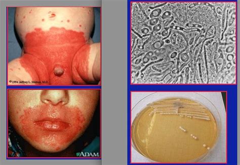 Flashcards Skin Disease W Maculopapular Rash Roseola Erythema Infectiosum StudyBlue