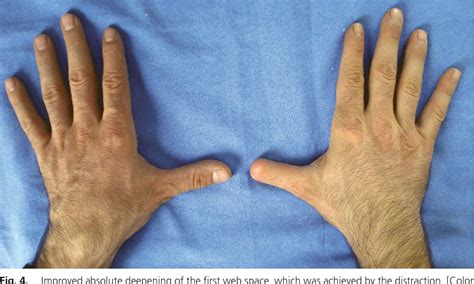 Figure 4 From Distraction Lengthening Of The Proximal Phalanx In Distal
