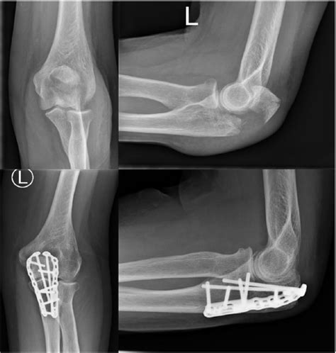 Fractures Of The Proximal Ulna Current Concepts In Surgical Management
