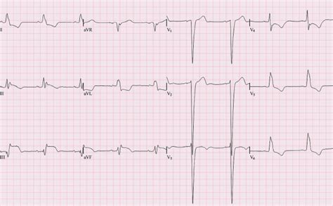 Left Bundle Branch Block With Acute Inferior Wall M I Ecg Guru