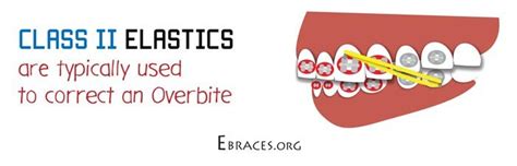 Everything You Need To Know About Rubber Bands For Braces