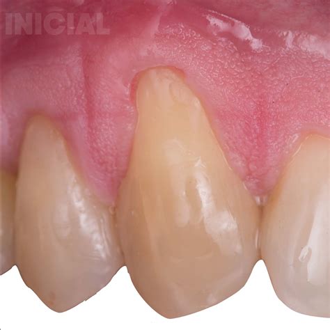 Root Coverage Procedures My First Time 8 Golden Rules On Esthetic