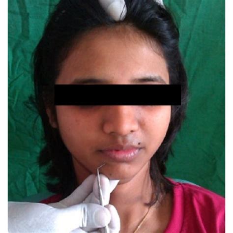 Two Point Discrimination Test Download Scientific Diagram