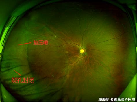 视网膜上破了个洞？这种治疗方式简单有效视网膜新浪财经新浪网