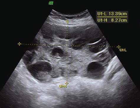 Figure 1 From Sonographic Detection Of The Ovarian Hyperreactio Luteinalis In Pregnancy