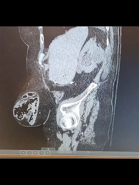 Large Inoperable Ventral Hernia With Unsuspected Find Rradiology