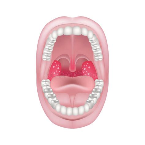 Amigdalitis Aguda Y Faringitis Hinchazón Y Enrojecimiento De Las