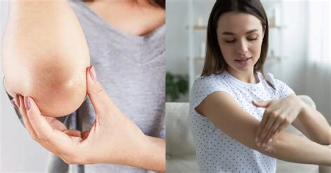 ¿por Qué Algunas Personas Tienen Los Codos Secos Y Otras No Infobae