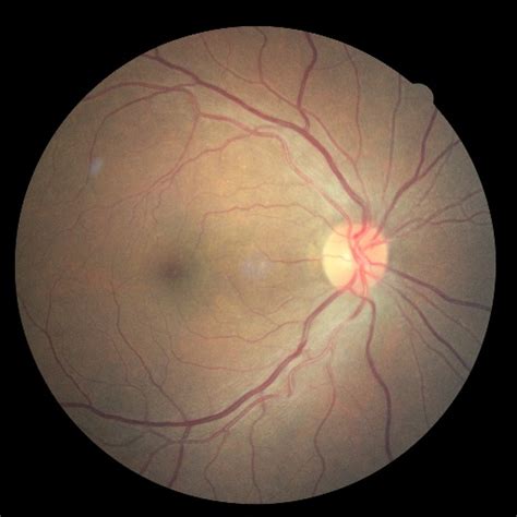 Github Mohamedbakrey12classification Eye Diseases And Deployment