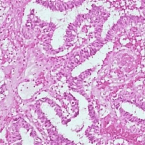 Papillary Carcinoma In A 37 Year Old Female Download Scientific Diagram