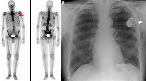 Can You Have A Bone Scan With A Pacemaker