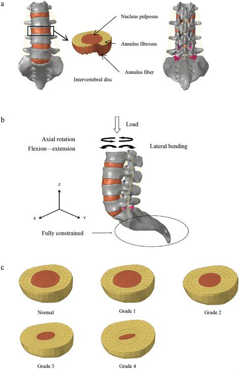 Finite Element Model Of The Lumbar Spine L2 S1 A Intervertebral Download Scientific Diagram