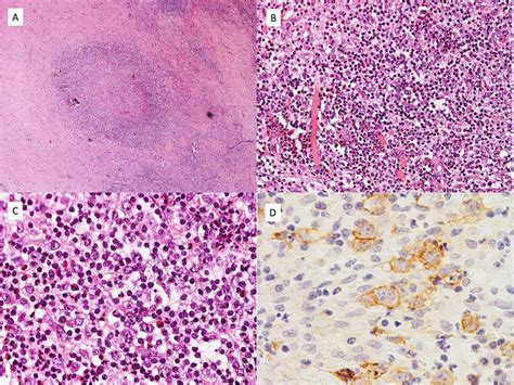 Pathological Images Of The Lesion A Lymphoid Nodule Surrounded By Download Scientific Diagram
