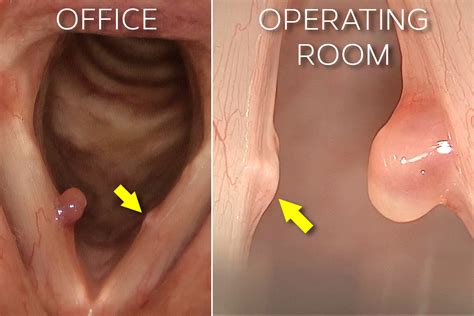 Polyp Reactive Nodule Voice Surgeon