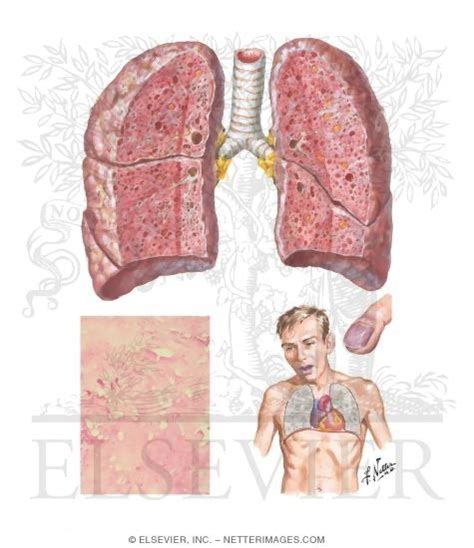 Idiopathic Diffuse Interstitial Pulmonary Fibrosis Hamman Rich Disease