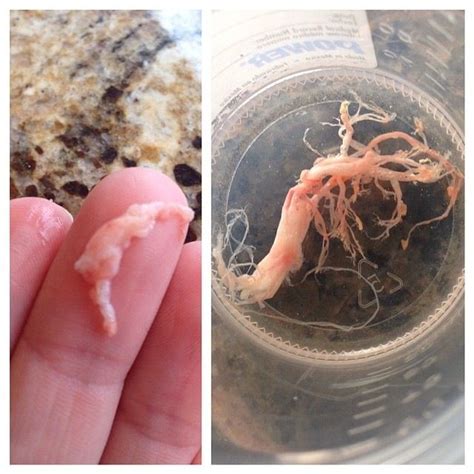 Plastic Bronchitis Specimen Diy Beauty Beauty Hacks Specimen Plastic