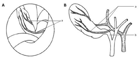 Cystic Artery Variations