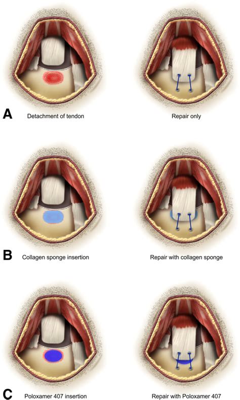 Illustration Of Rotator Cuff Repair In A Rat Model A Detachment Of Download Scientific
