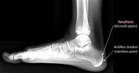 Severs Disease Charissa Fermelis