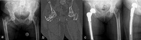 A Pathological Femoral Fracture Due To Metastatic Breast Cancer Shown Download Scientific