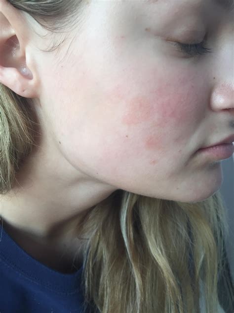 Red Spots On Face Not Acne My XXX Hot Girl