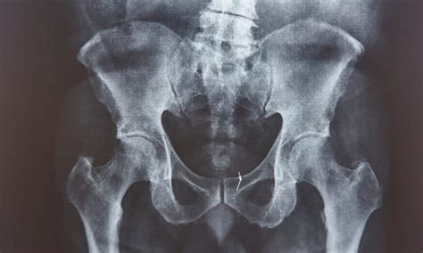 Flexible X Ray Detectors Could “revolutionise” Cancer Care Health Tech World